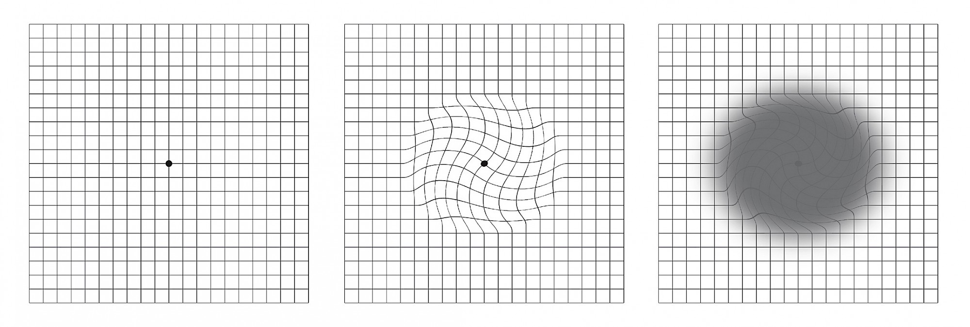 Makuladegeneration (AMD) –— Augenspezialisten Saar